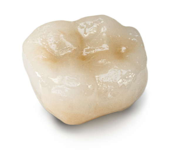 Porcelain Fused to Metal (PFM) Crowns – MCL Dental Lab