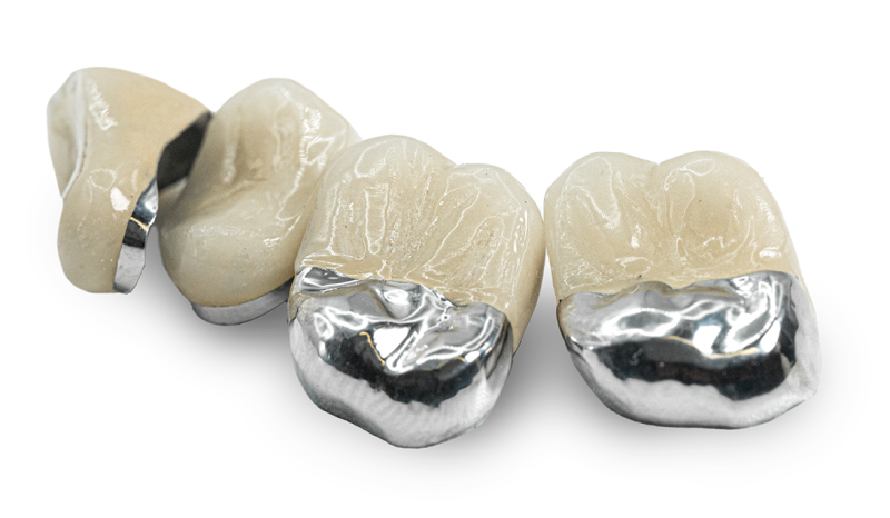 Porcelain Fused to Metal (PFM) Crowns – MCL Dental Lab
